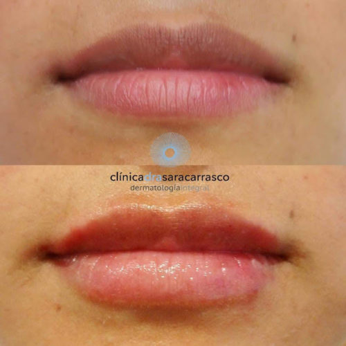 Ácido hialuronico en labios antes y después - Grupo Sara Carrasco